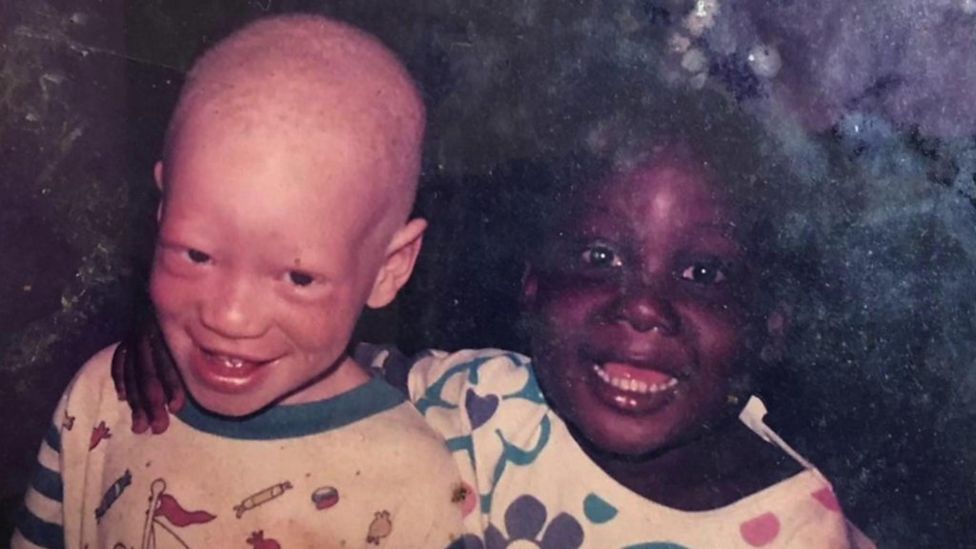 Somalis with albinism: Pelted with stones and raw eggs - BBC News