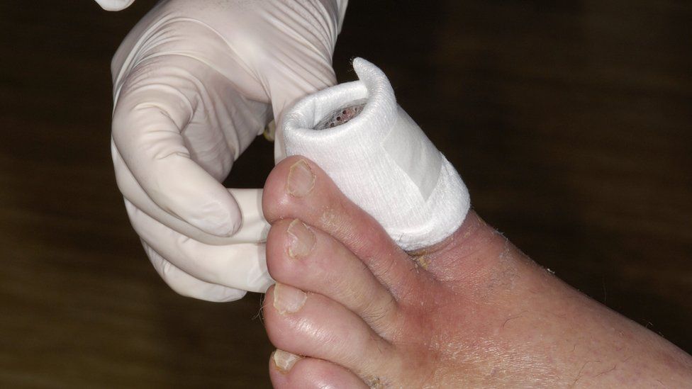 Call for action against 'twin scourge' of diabetes and TB - BBC News