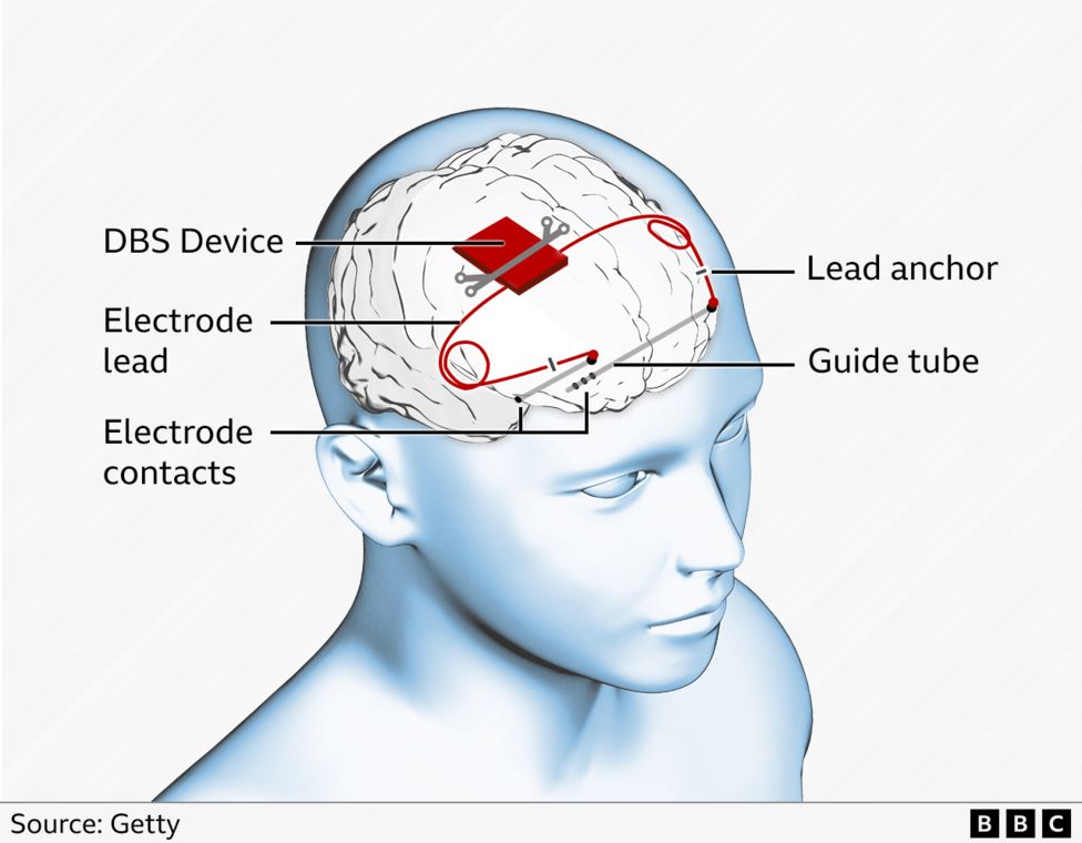 World first epilepsy device fitted in UK boy's skull - BBC News