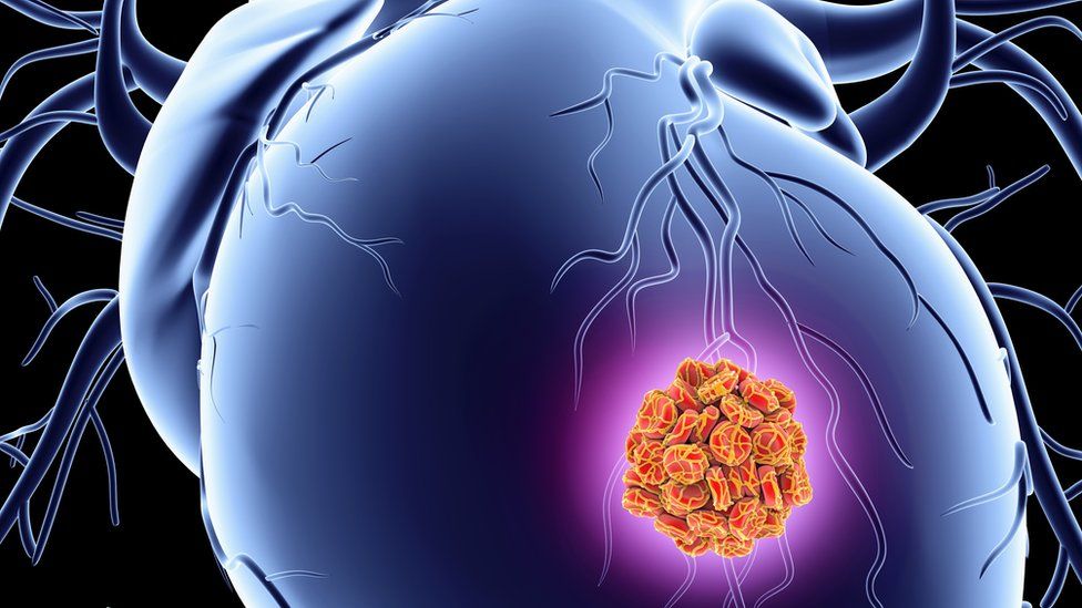 Patch may boost repair after heart attack - BBC News