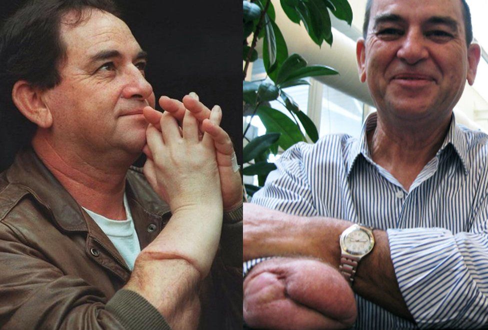 What's it like living with a face transplant? - BBC News