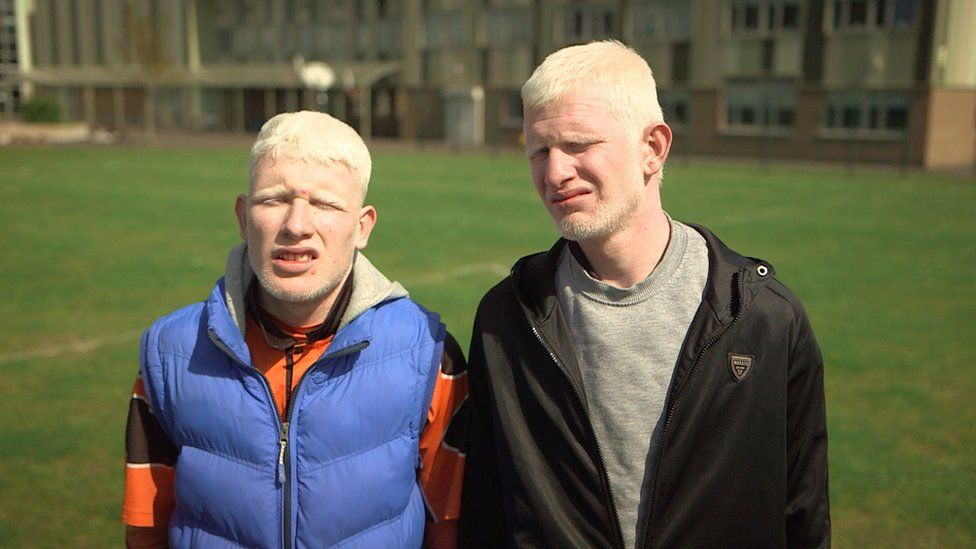 Living with albinism in the UK - BBC News
