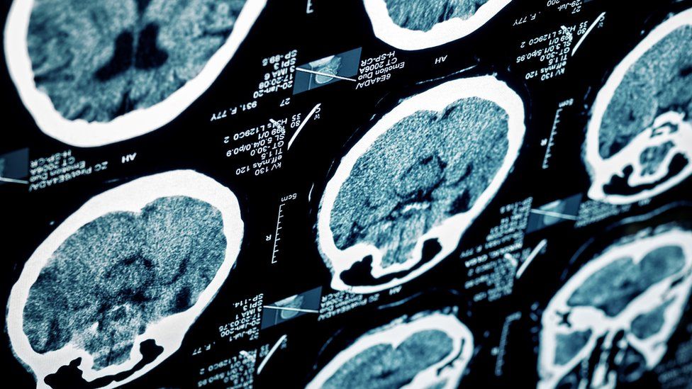 Drinker diagnosed with brain damage from alcohol - BBC News