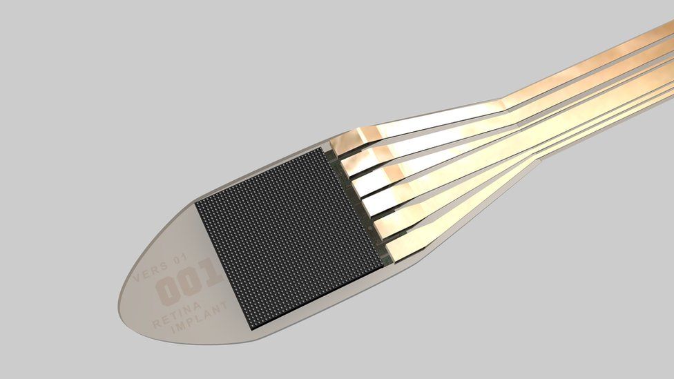 Sight joy for Cardiff woman fitted with a 'bionic eye' - BBC News