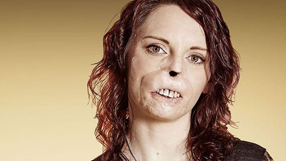 The children living with facial disfigurements - BBC News