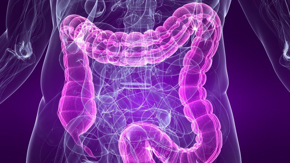 Colon cancers 'more deadly on right' - BBC News