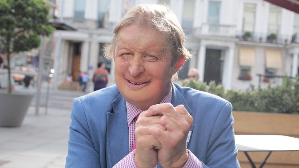 What's it like living with a face transplant? - BBC News