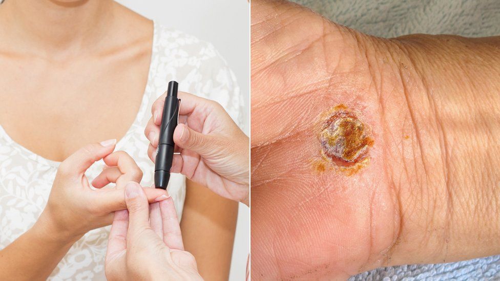 Bangor University developing gel for chronic diabetic wounds - BBC News