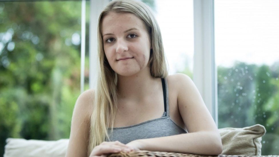 Teenager's jaw rebuilt after horror horse accident in Derbyshire - BBC News