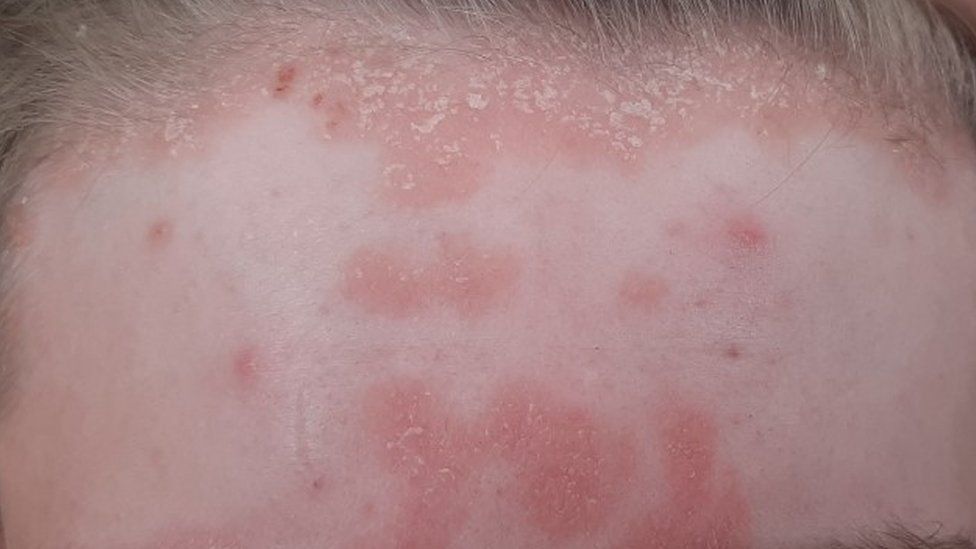 Milton Keynes mother says mould in flat caused son's skin condition ...