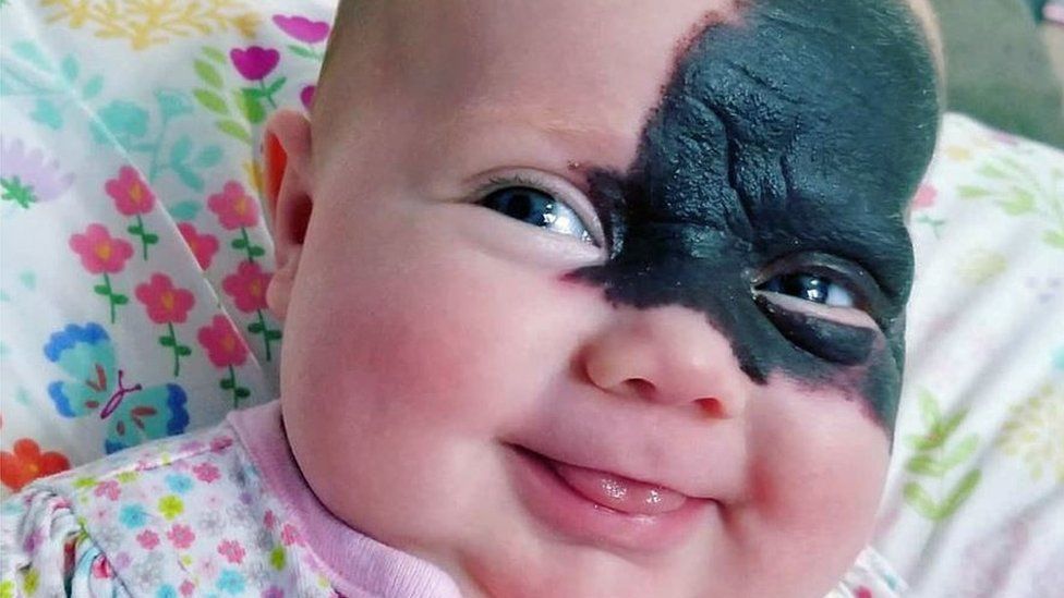 Ellesmere Dad gets tattoo of daughter's large birthmark - BBC News
