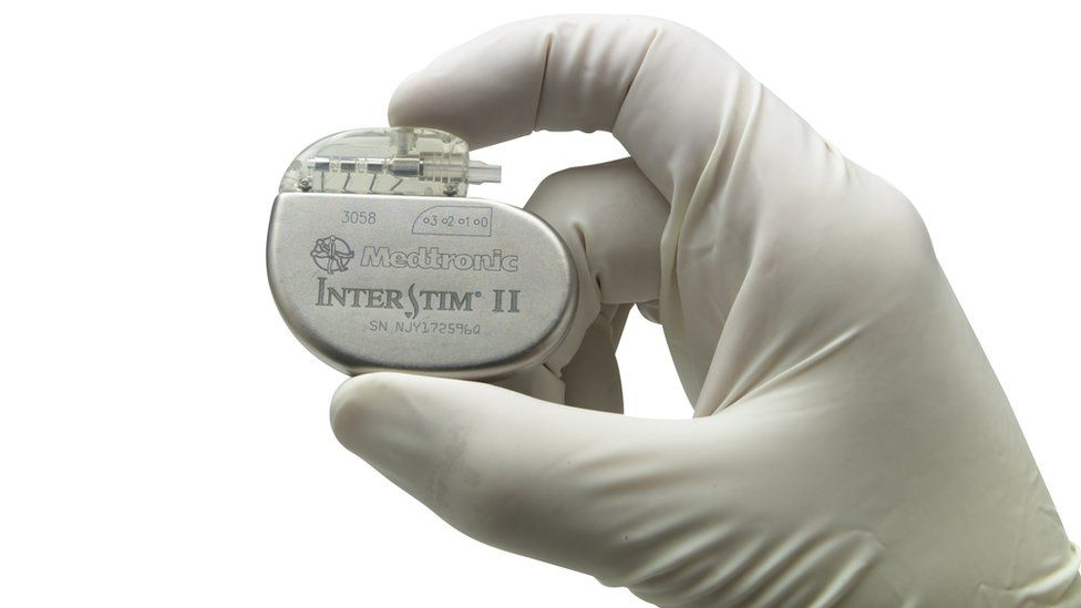 Implant call for Welsh patients with bowel condition - BBC News