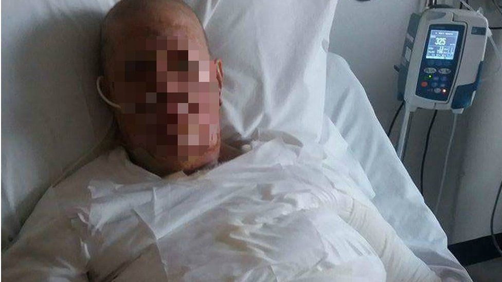 Derbyshire woman turned into a 'human fireball' - BBC News