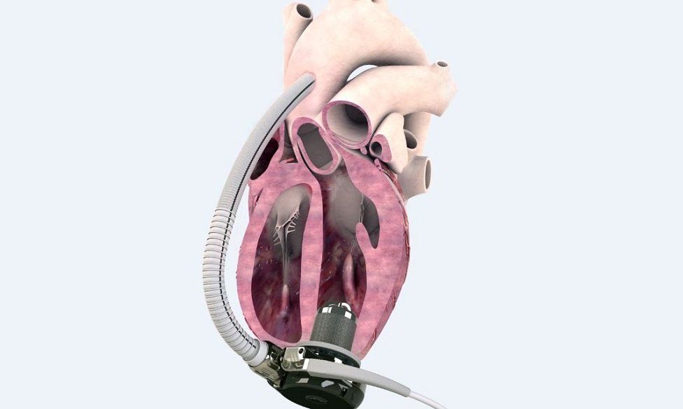 What's it like to live with a mechanical heart pump? - BBC News