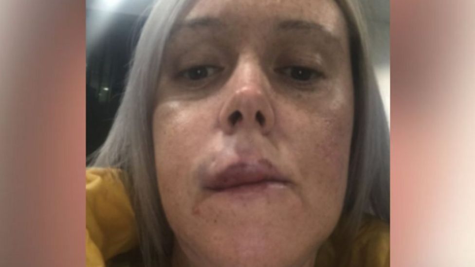 Lip fillers: Call for tighter regulation after botched treatments - BBC ...