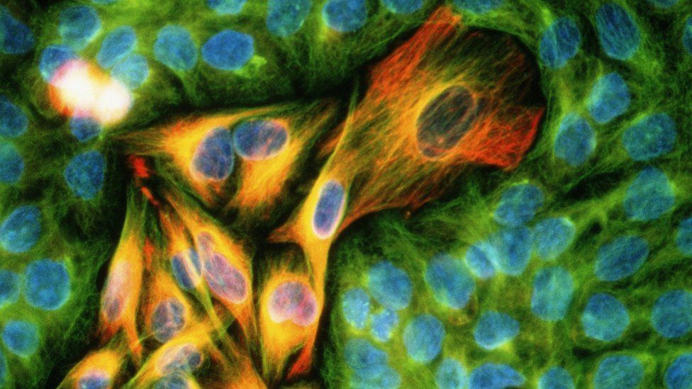 Pioneering cancer drug combination approved - BBC News