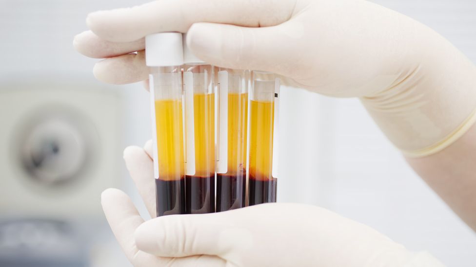 Contaminated blood: Psychology service for victims starts - BBC News