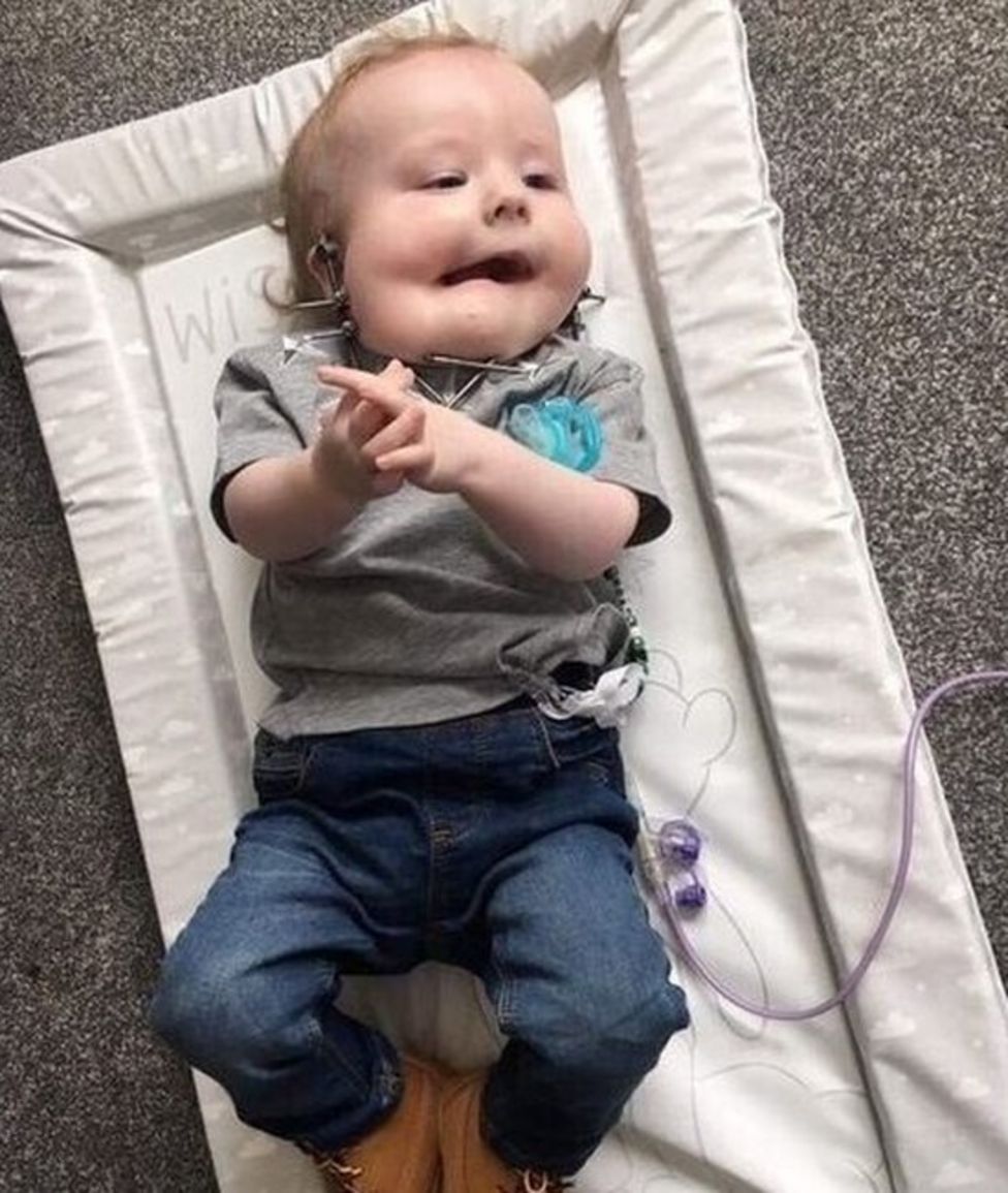 Jaw 'scaffolding' operation helps our baby breathe - BBC News