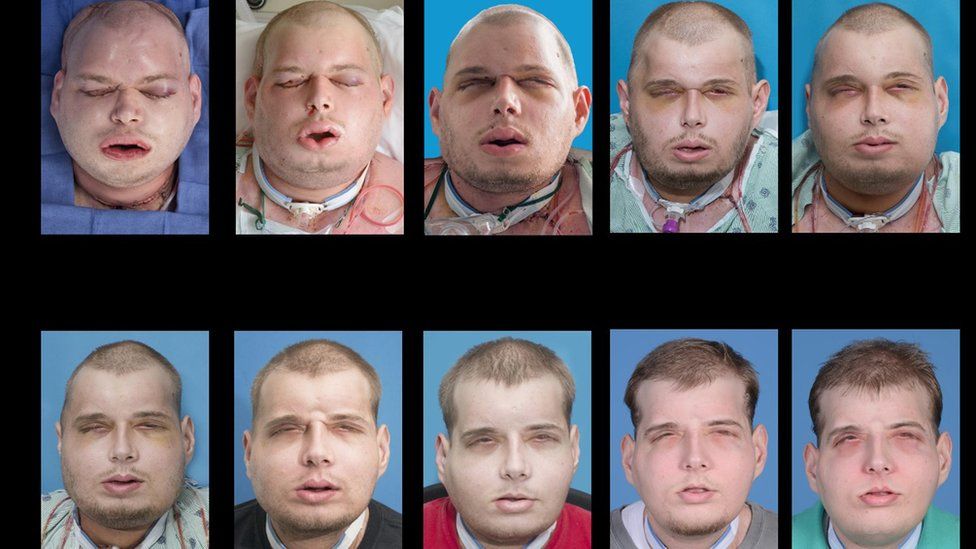 How to build a whole new face - BBC News