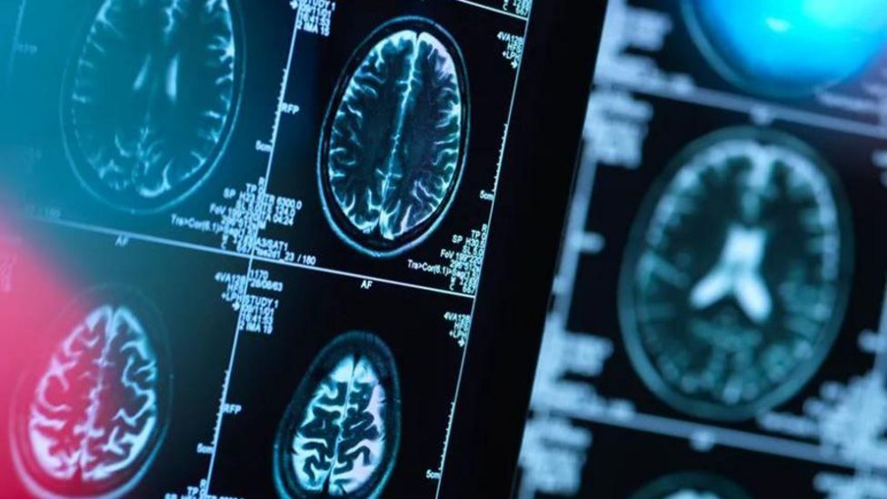Deep brain stimulation service failings at Birmingham NHS trust for ...