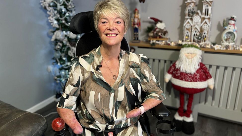 Amputee defies doctors by walking after five years - BBC News