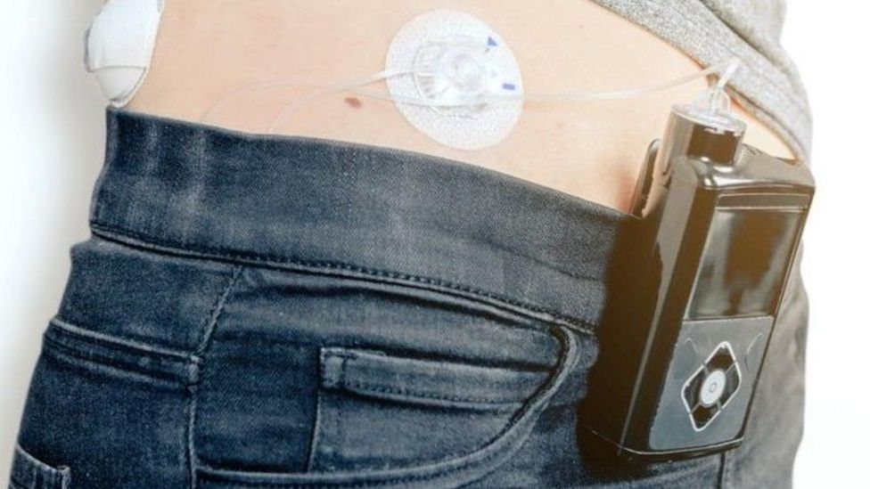 Type 1 diabetes: breakthrough treatment could be offered in NI - BBC News