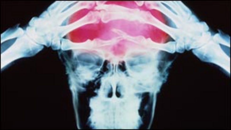 Migraine cause 'identified' as genetic defect - BBC News