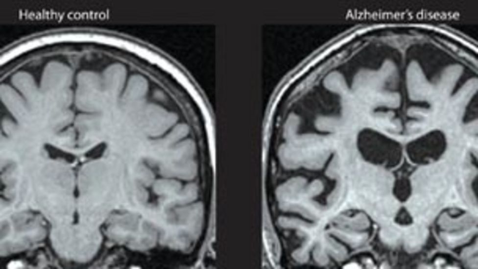 Test for early Alzheimer's 'seems possible' - BBC News