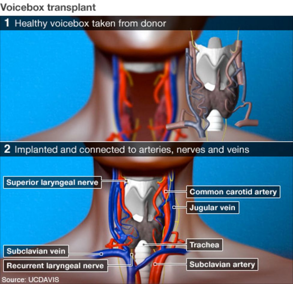 Brenda Jensen's voice restored after larynx transplant - BBC News