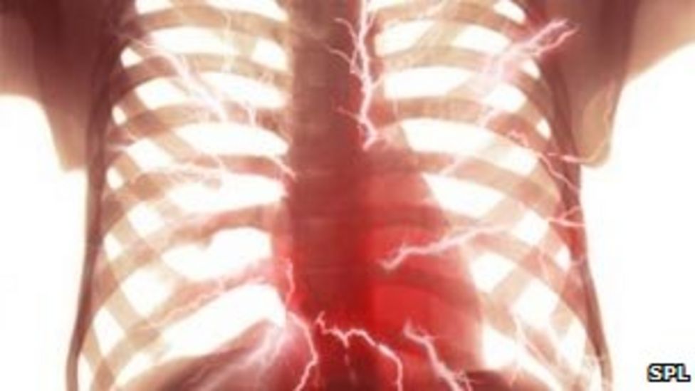 Heart attacks deaths halved in the last decade, experts say - BBC News