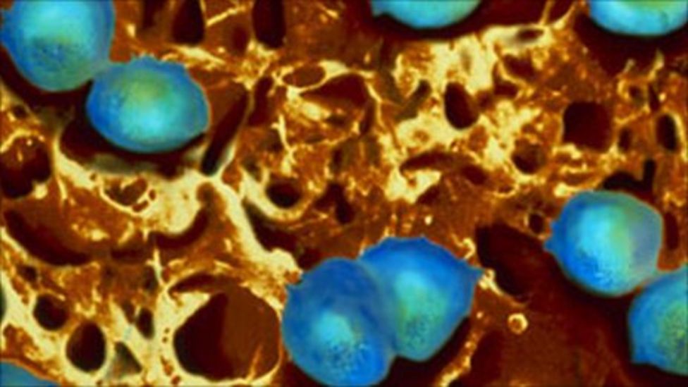 'Super-gonorrhoea' outbreak in Leeds - BBC News