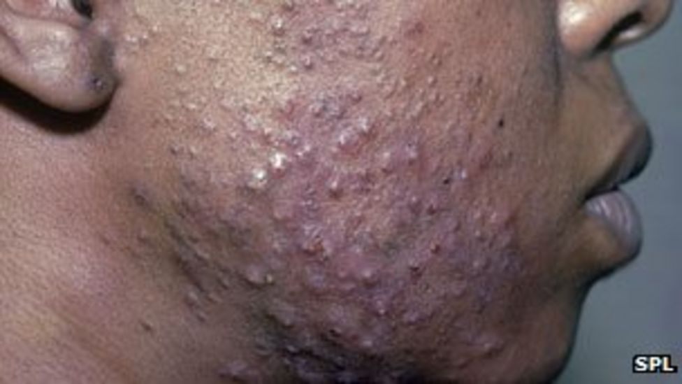 Why Spotting The Best Acne Treatment Is A Pain BBC News