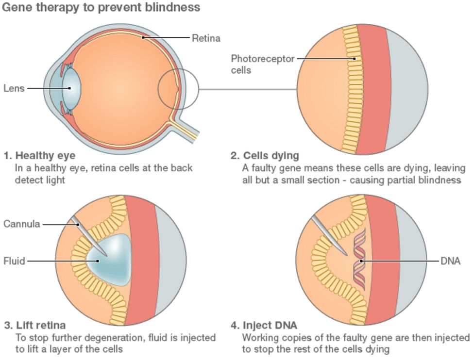 Gene therapy 'could be used to treat blindness' - BBC News
