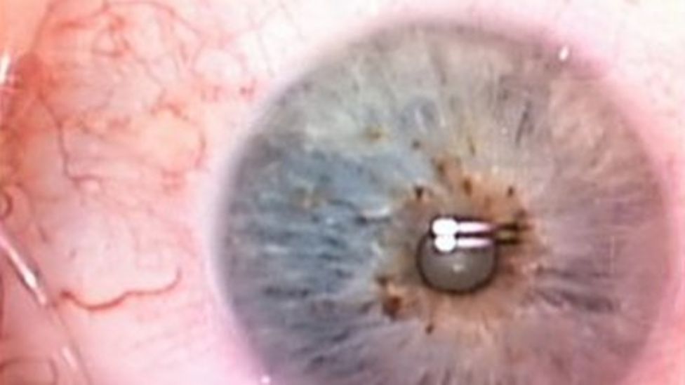 Gene therapy reverses sight loss and is long-lasting - BBC News