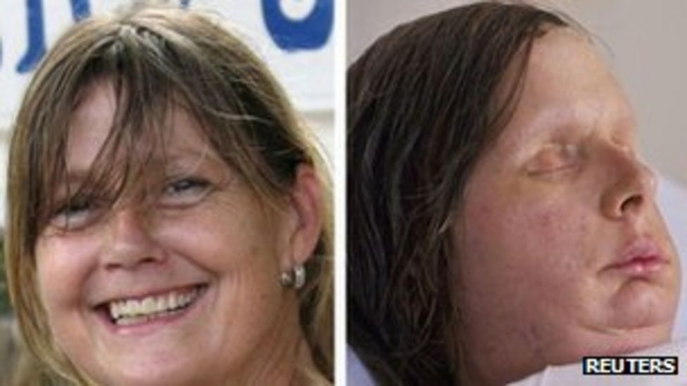 US chimp-attack victim says state failed to heed warning - BBC News