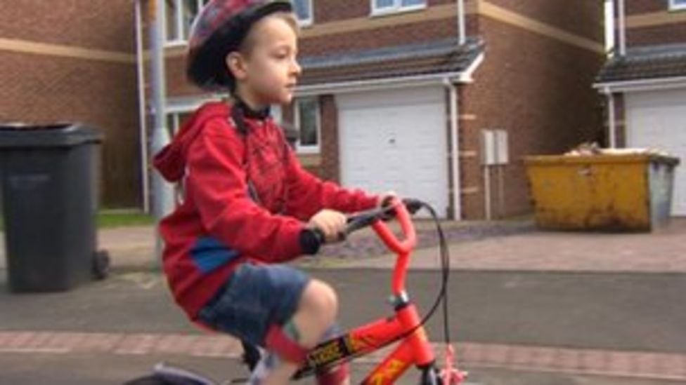 Cerebral palsy op boy Archie Anderson recovering - BBC News