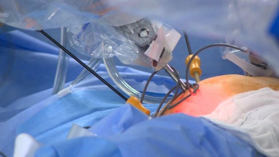 Robotic surgery linked to 144 deaths in the US - BBC News