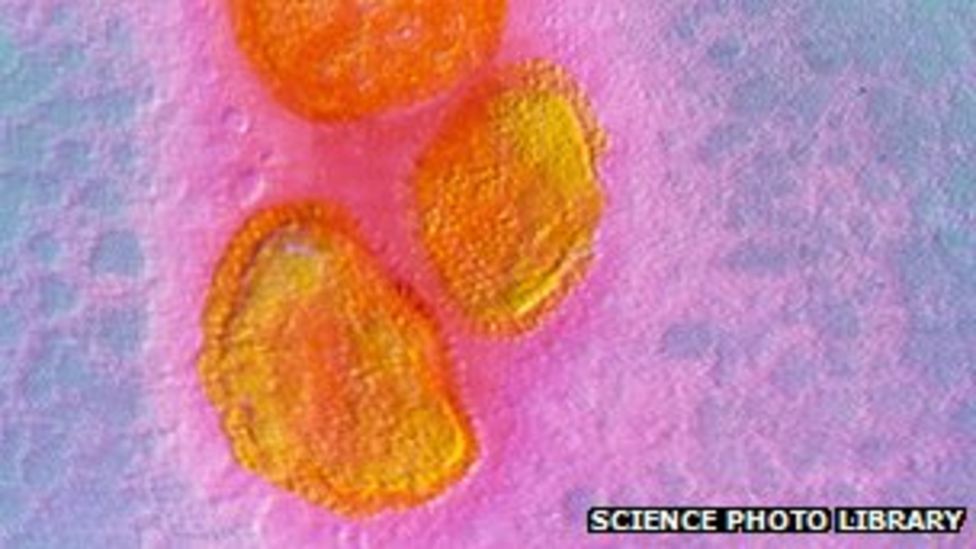 Mumps cases in north-east England quadruple - BBC News