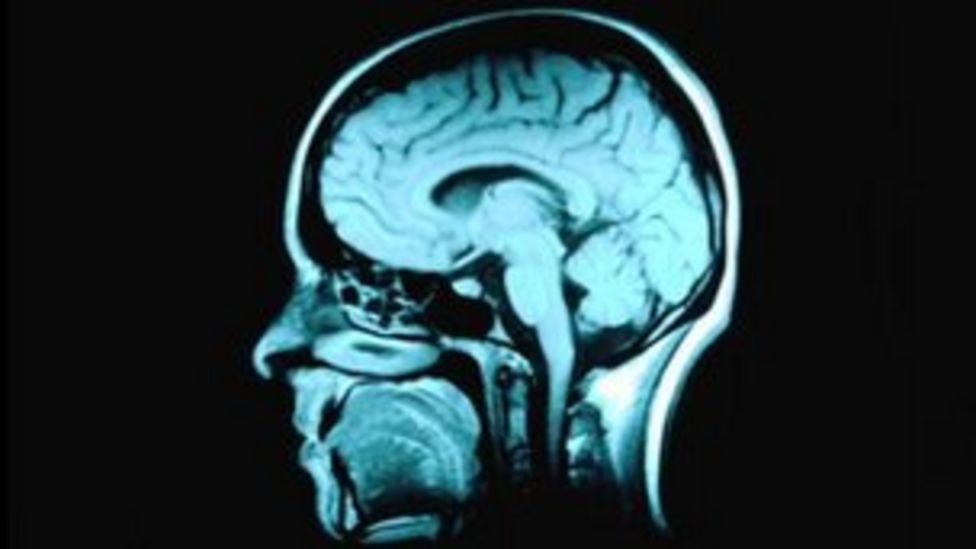 Epilepsy 'is a global health problem' - BBC News