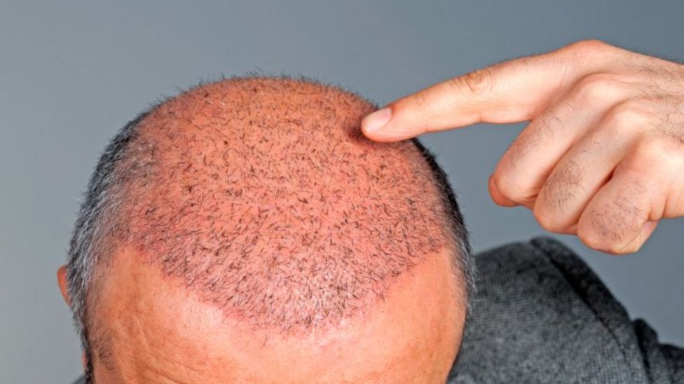 Early baldness higher heart disease risk factor than obesity, says ...