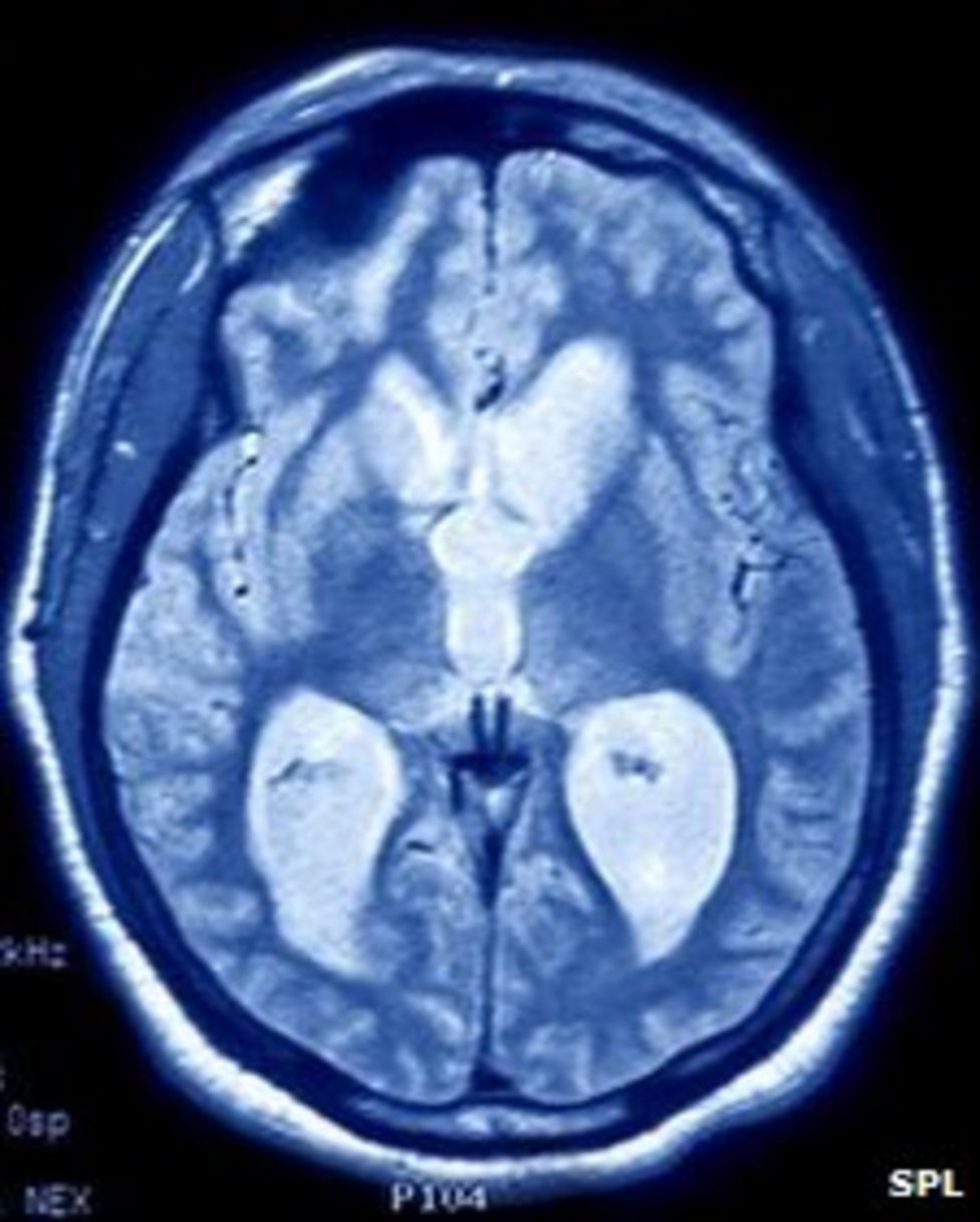'Holy Grail' technique in treating stroke patients - BBC News