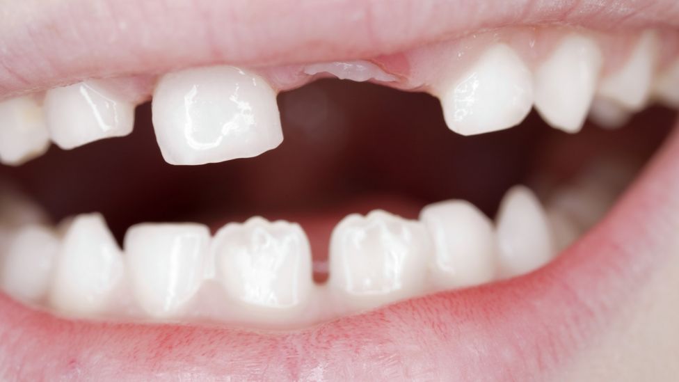 Poor people 'have fewer teeth' than rich, study suggests - BBC News