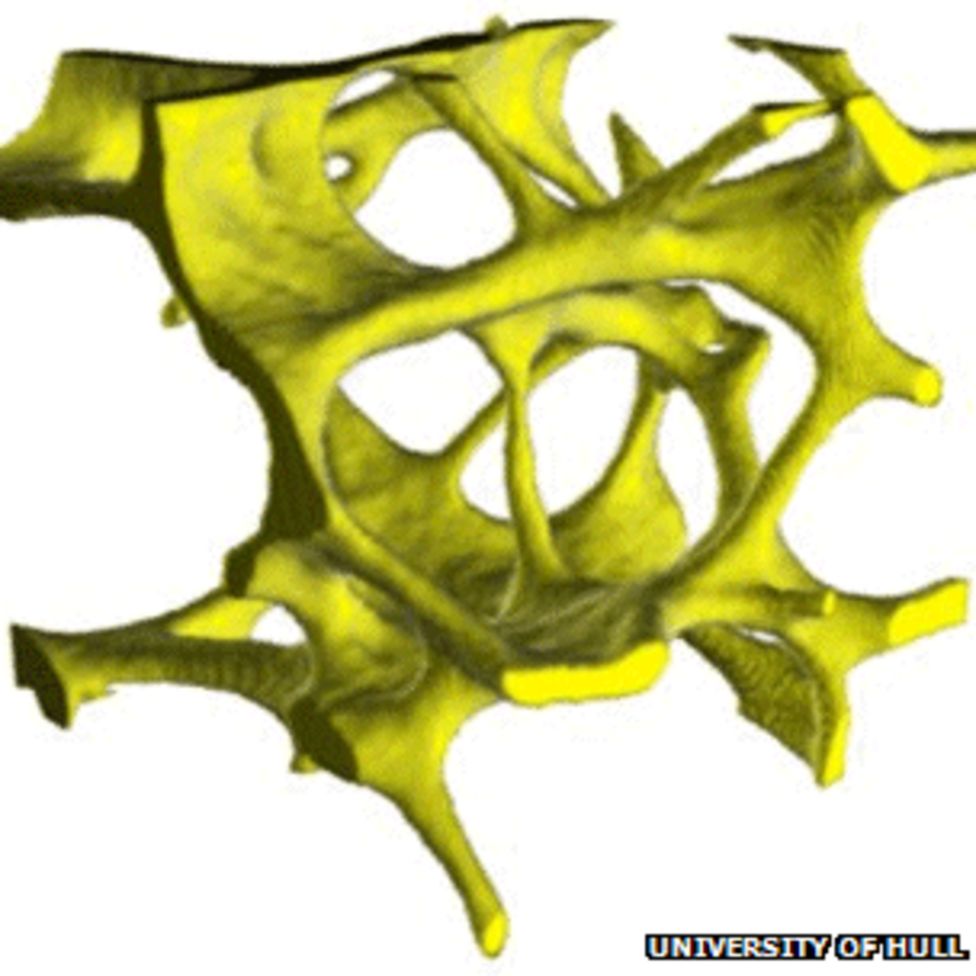 Modelling hip joint disease using 3D engineering tool - BBC News