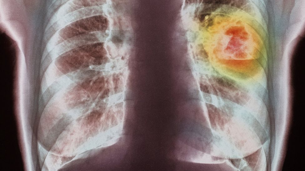 Most cancer types 'just bad luck' - BBC News