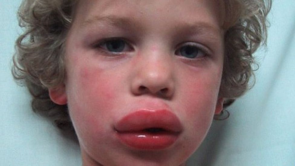 'Cleaner world' increases allergy hospital admissions by 33% in five ...