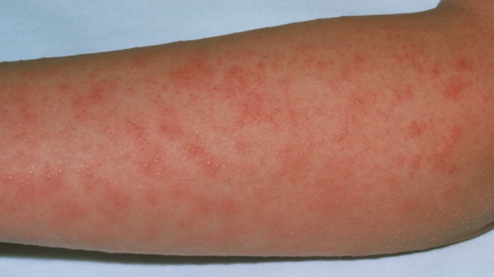 Rise in scarlet fever cases shows 49-year high, health experts say ...