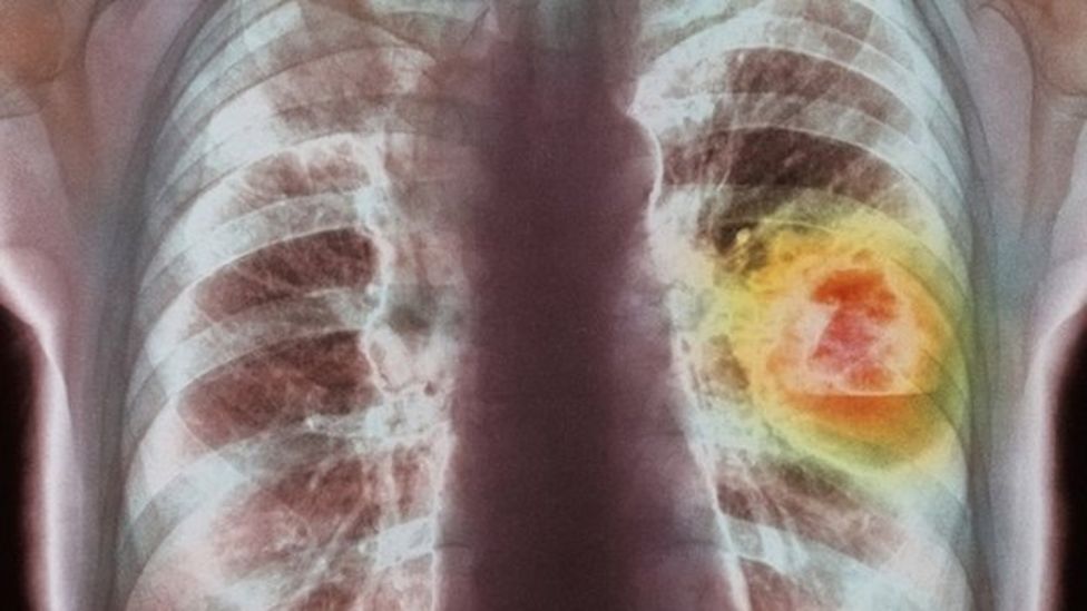 Should we expect more on cancer? - BBC News