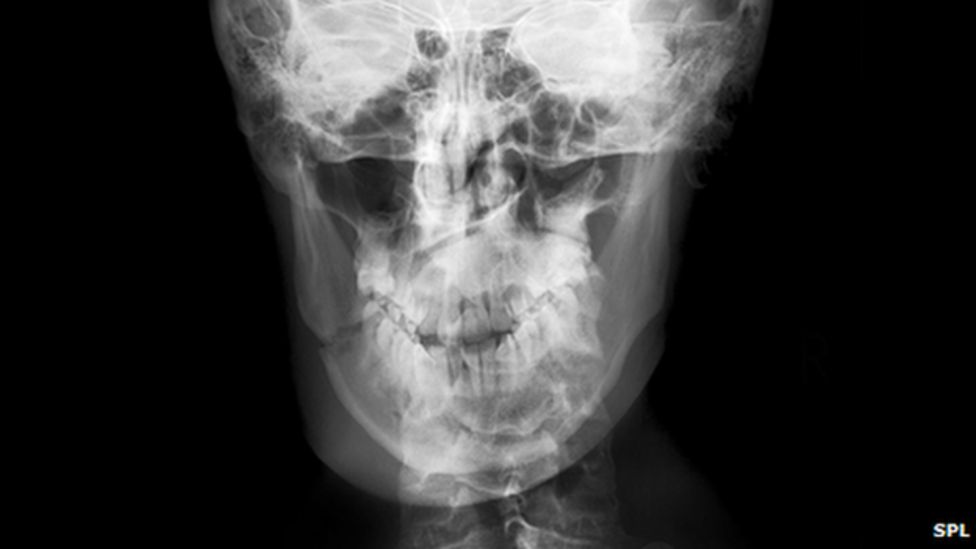 Male faces 'buttressed against punches' by evolution - BBC News