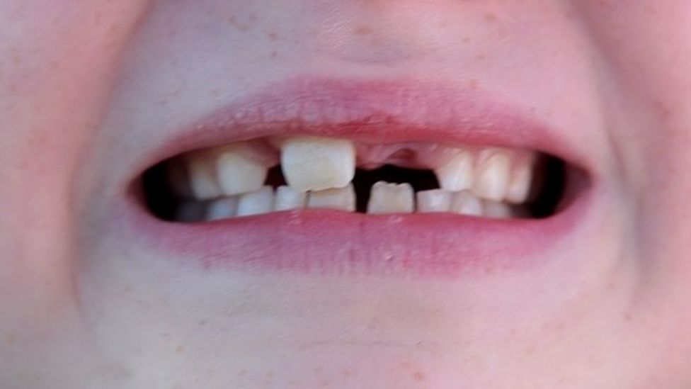 Dental charity blames bad baby teeth on 'child neglect' - BBC News