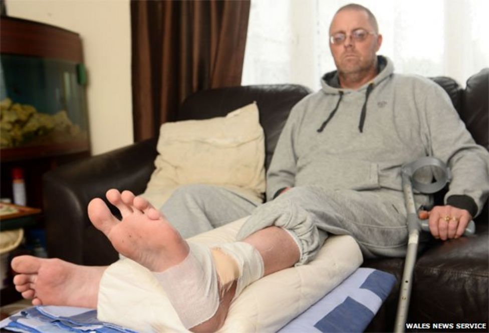 Barry gardener's leg surgery after false widow spider bite - BBC News